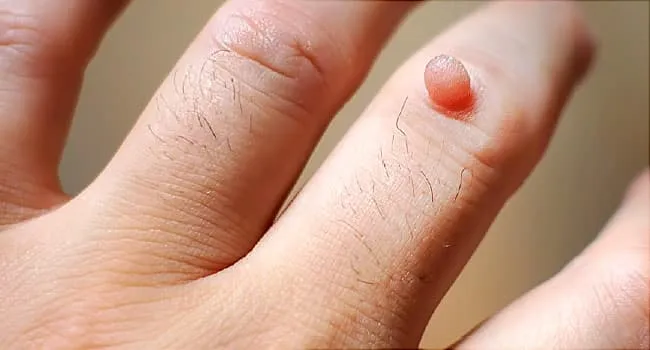hand flat wart