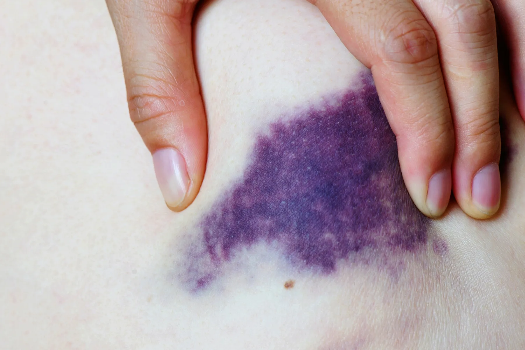 Why Do I Bruise Easily Reasons It May Happen