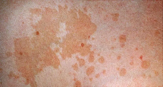 Pictures of Blotchy Skin: Rosacea, Hives, Psoriasis, and More