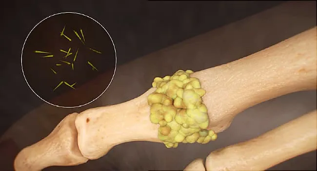 Gout Causes, Symptoms, and Treatments