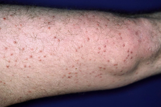 Pictures Of Skin Problems Linked To Diabetes
