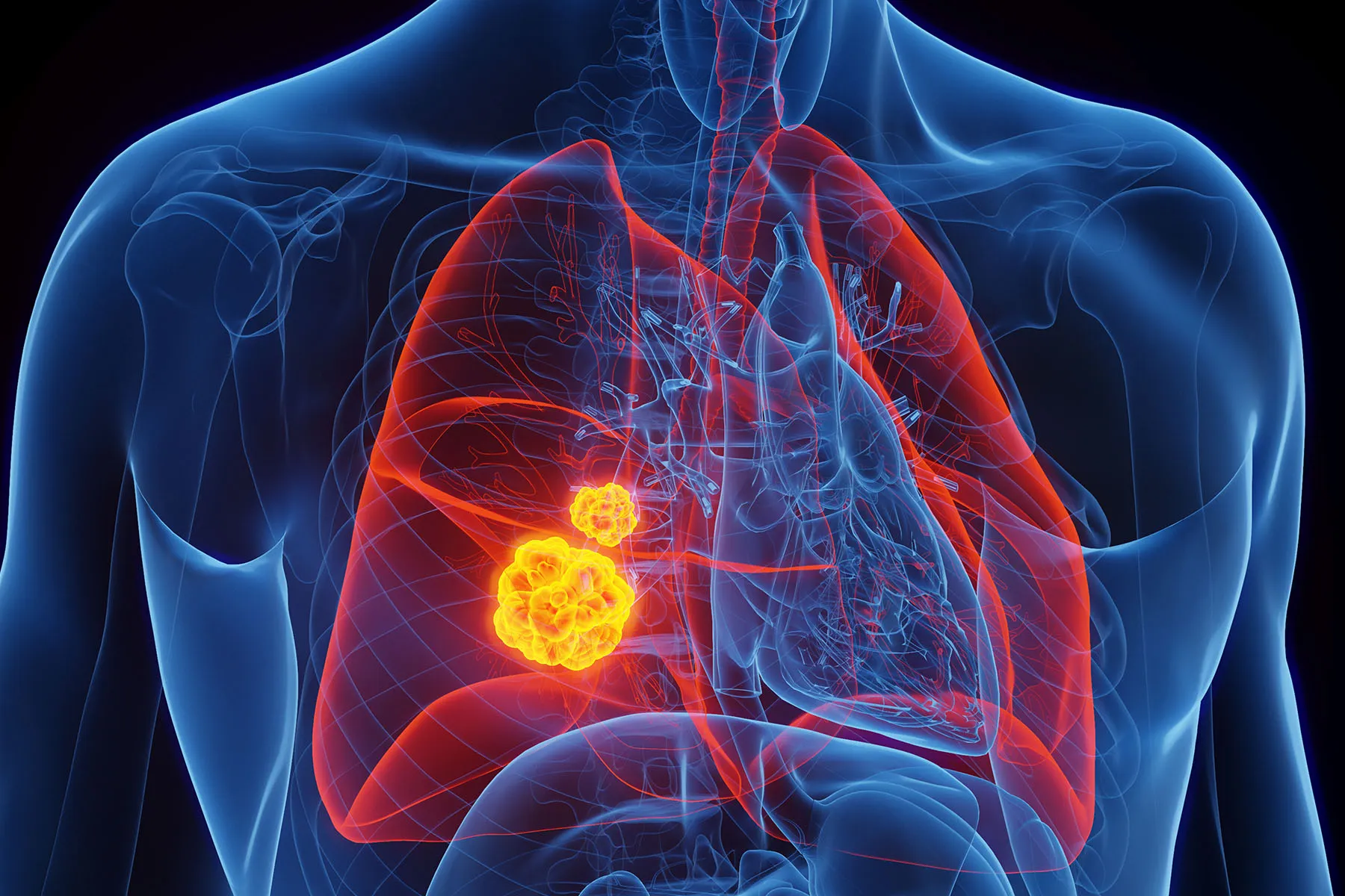 Immunotherapy for Lung Cancer