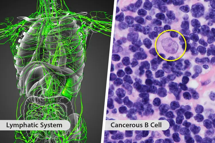 Mantle Cell Lymphoma (MCL): Causes, Symptoms, Treatment, and More
