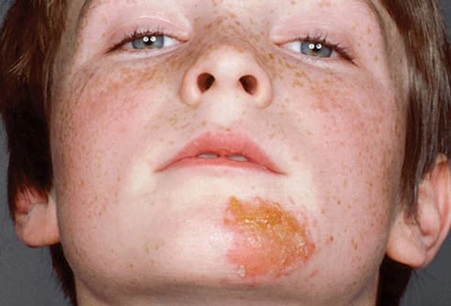 Myths And Facts About Shingles